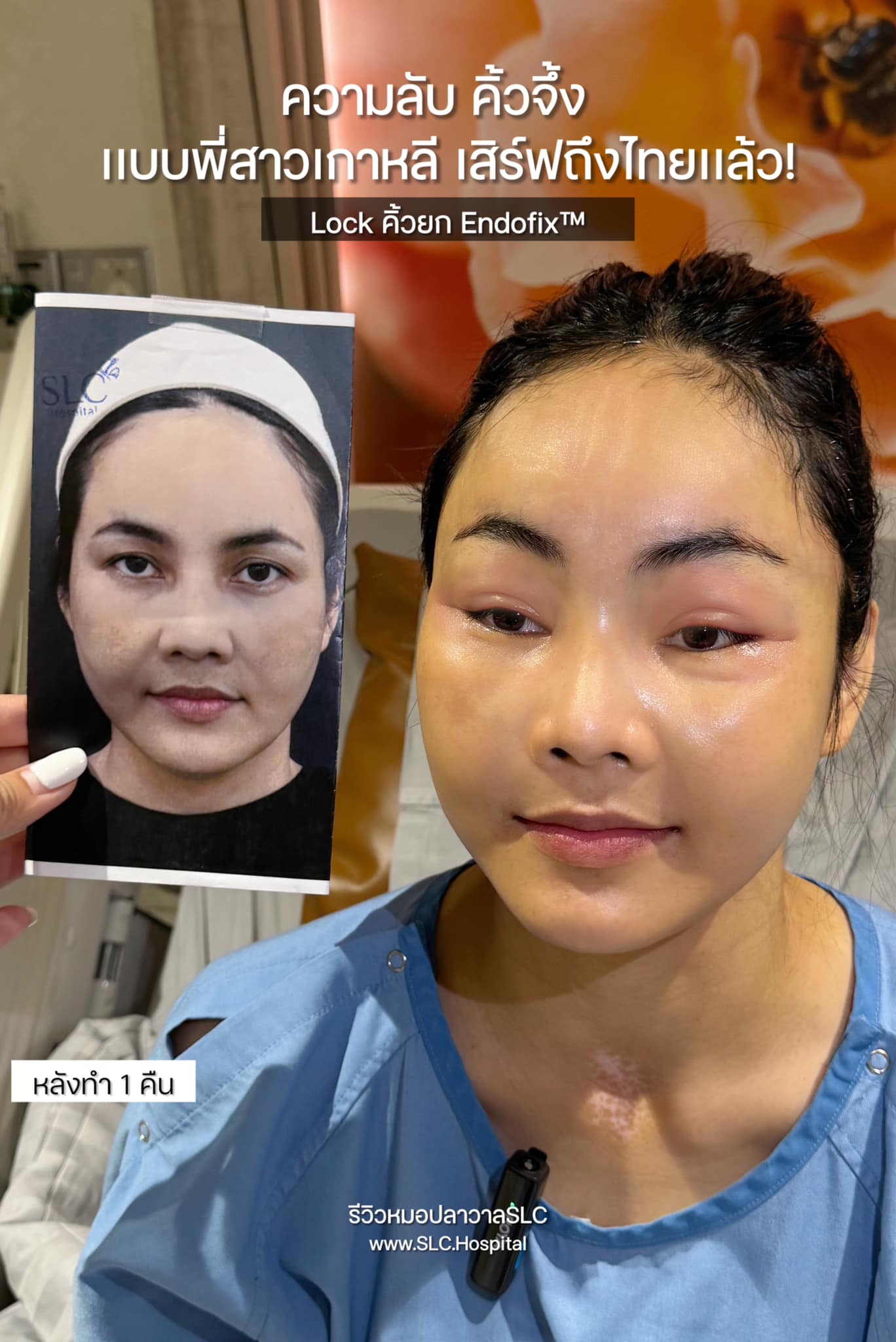 ความลับหน้าแบ๊ว ยกคิ้ว EndoFix™ เทคนิคใหม่ล่าสุดที่สายเกาต้องรู้