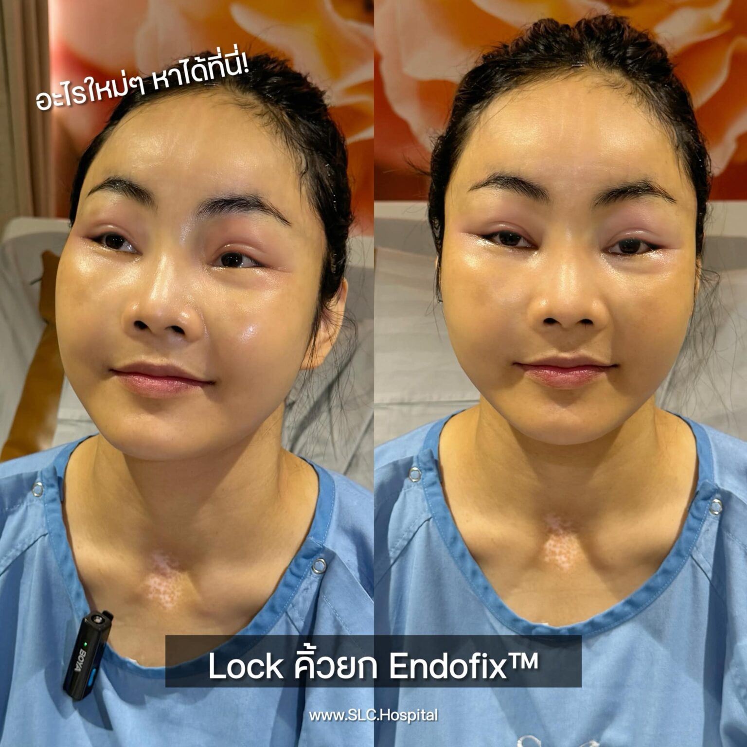 ความลับหน้าแบ๊ว ยกคิ้ว EndoFix™ เทคนิคใหม่ล่าสุดที่สายเกาต้องรู้